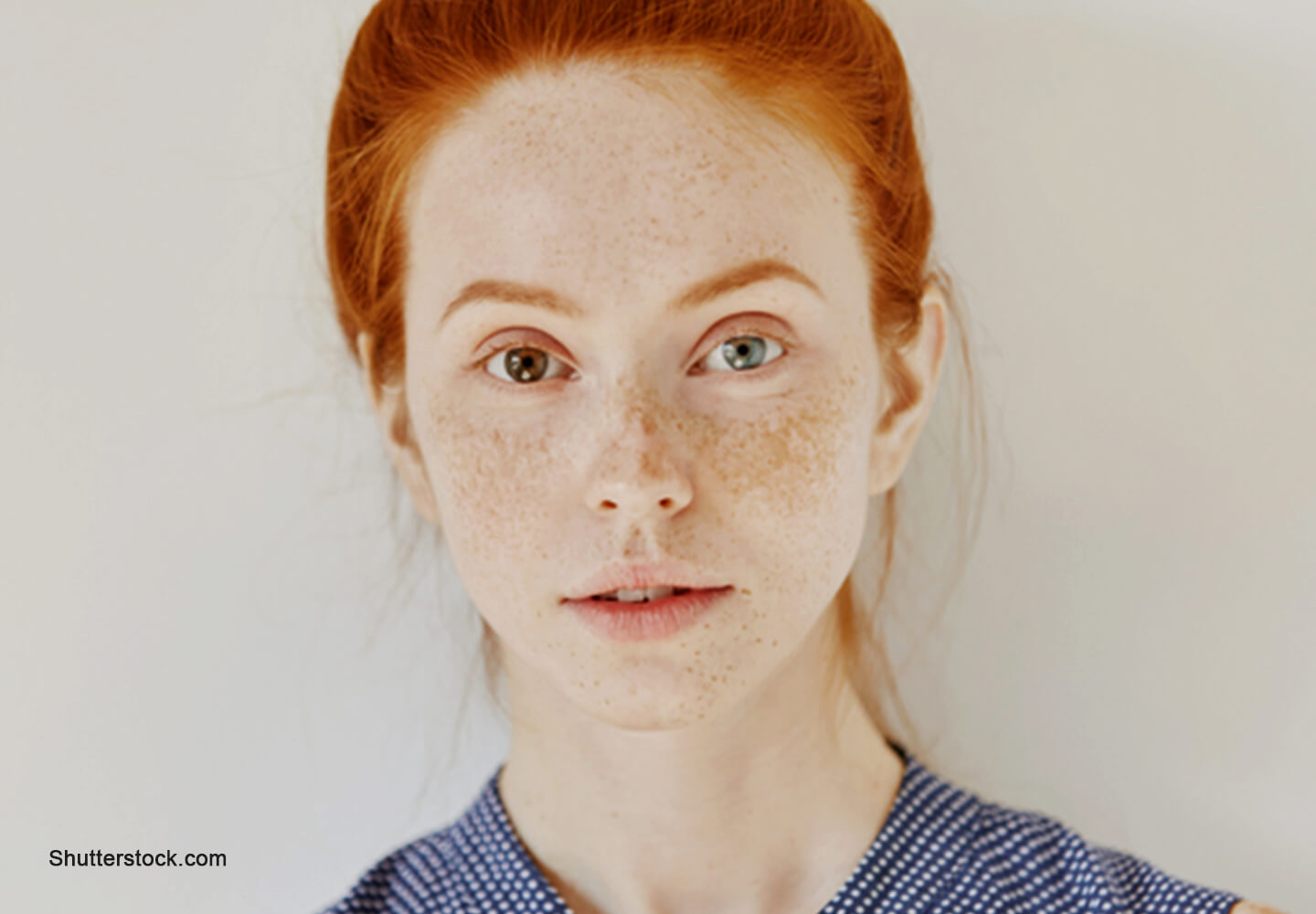 Crazy Llama - 10 Genetic Mutations That Make People Beautiful